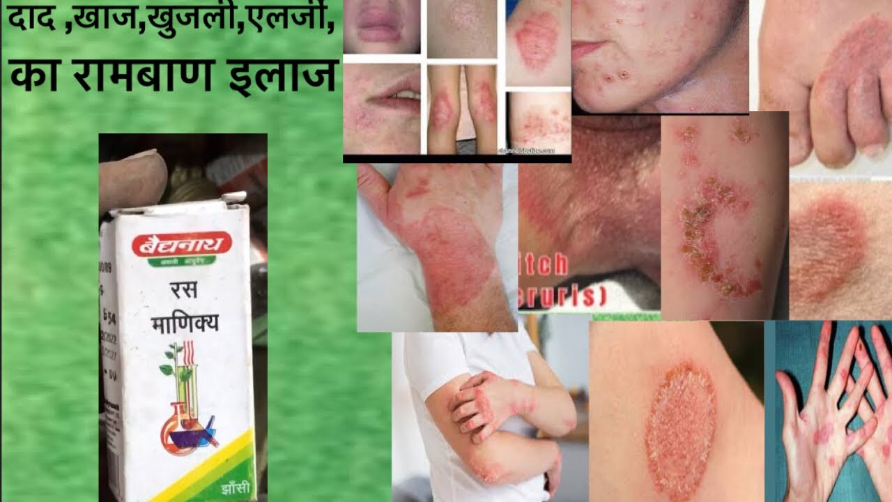 Ras Manikya Benefits, Uses & Dosage in hindi | त्वचा संबंधी समस्याओं ...