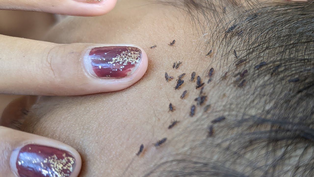 Help to clear those head louse from hair- How to reduce a thousand head ...