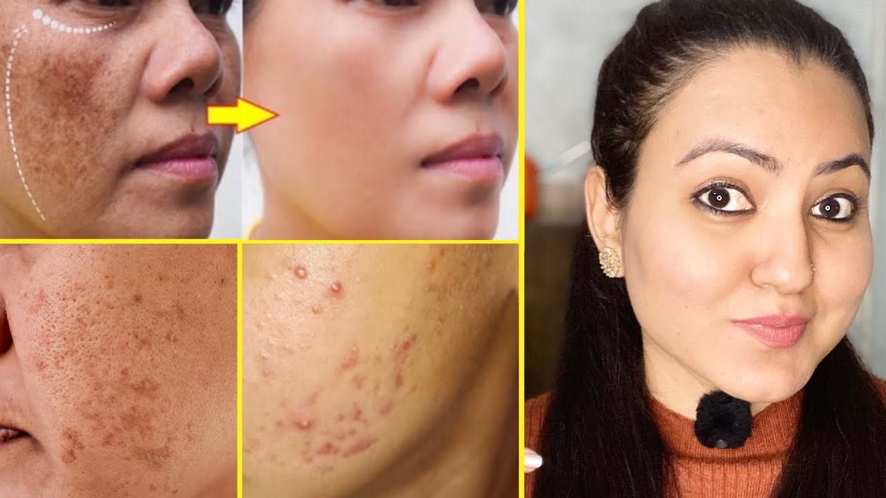 कितने भी पुराने Dark Spots, Hyperpigmentation, Freckles, Melasma हों, इस treatment से होगा 100% ...