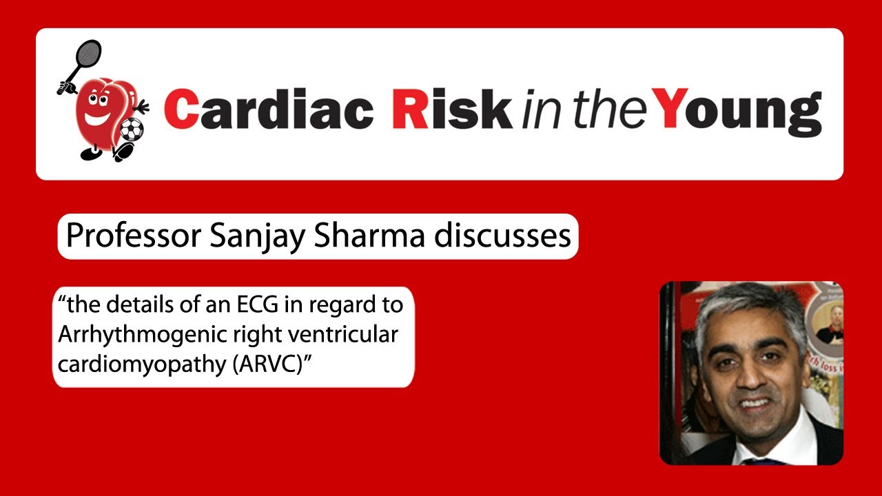 ECG 7: Arrhythmogenic right ventricular cardiomyopathy (ARVC) - YouTube