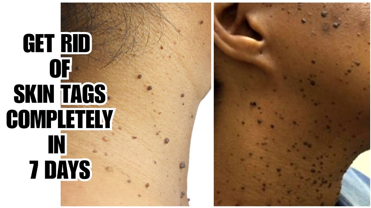HOW TO GET RID OF SKIN TAGS COMPLETELY/#skintag #organicskincare # ...