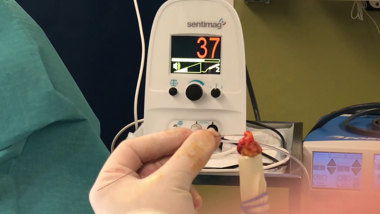 Targeted axillary dissection in breast cancer surgery - Michael Knauer ...