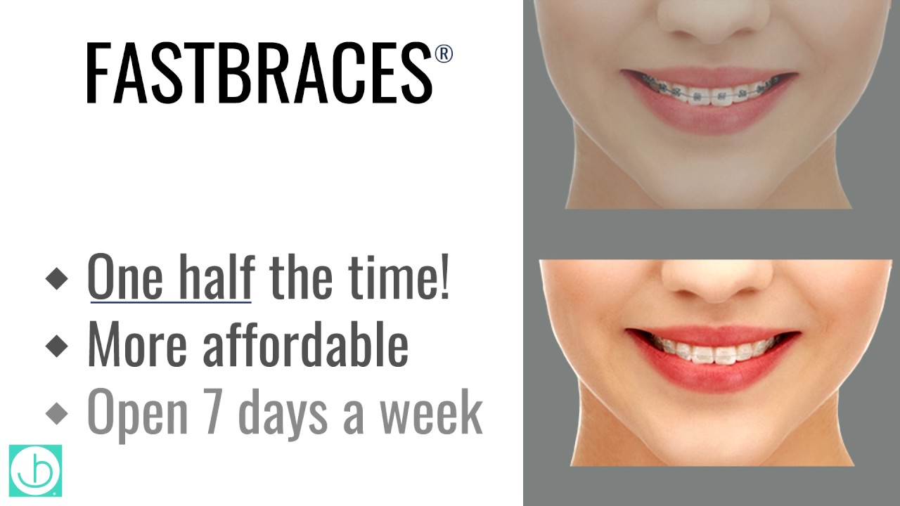 Braces Bar Facebook Campaign Video - YouTube