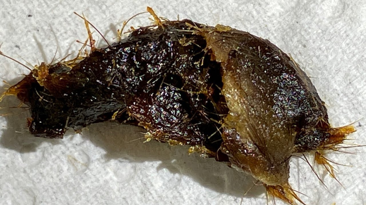 298 - Super Large Plug of Pitch Black Ear Wax Removed using the ...