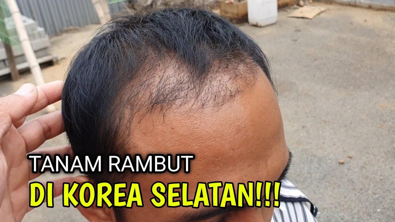 TANAM RAMBUT DI KOREA SELATAN - YouTube