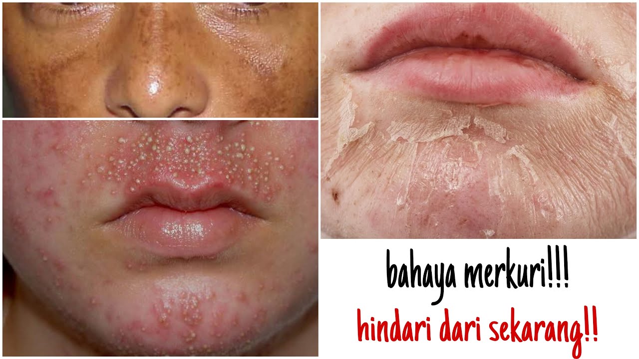 Ciri ciri wajah terkena merkuri || efek dari merkuri untuk tubuh ...