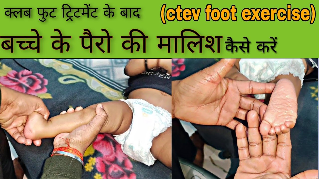 क्लब फूट पैरो में मालिश कैसे करें। how to exercise baby feet after ...