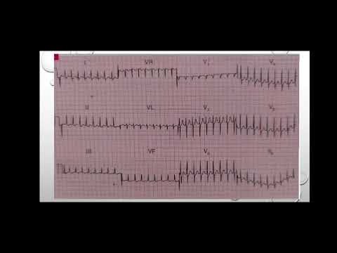 1: atrial fibrillation W digoxin effect, 2: SVT, 3: anterolateral ...