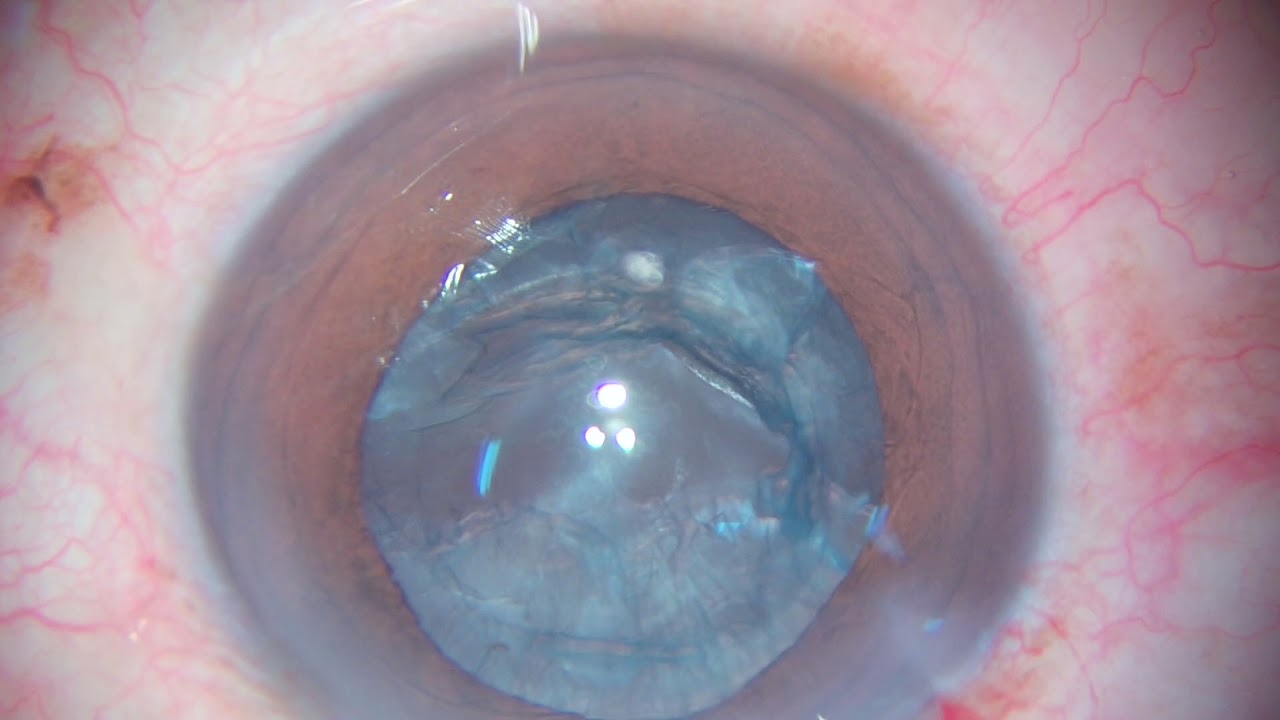 CLARION IQ LENS ALCON - DR RAJEEV HARDIA - YouTube