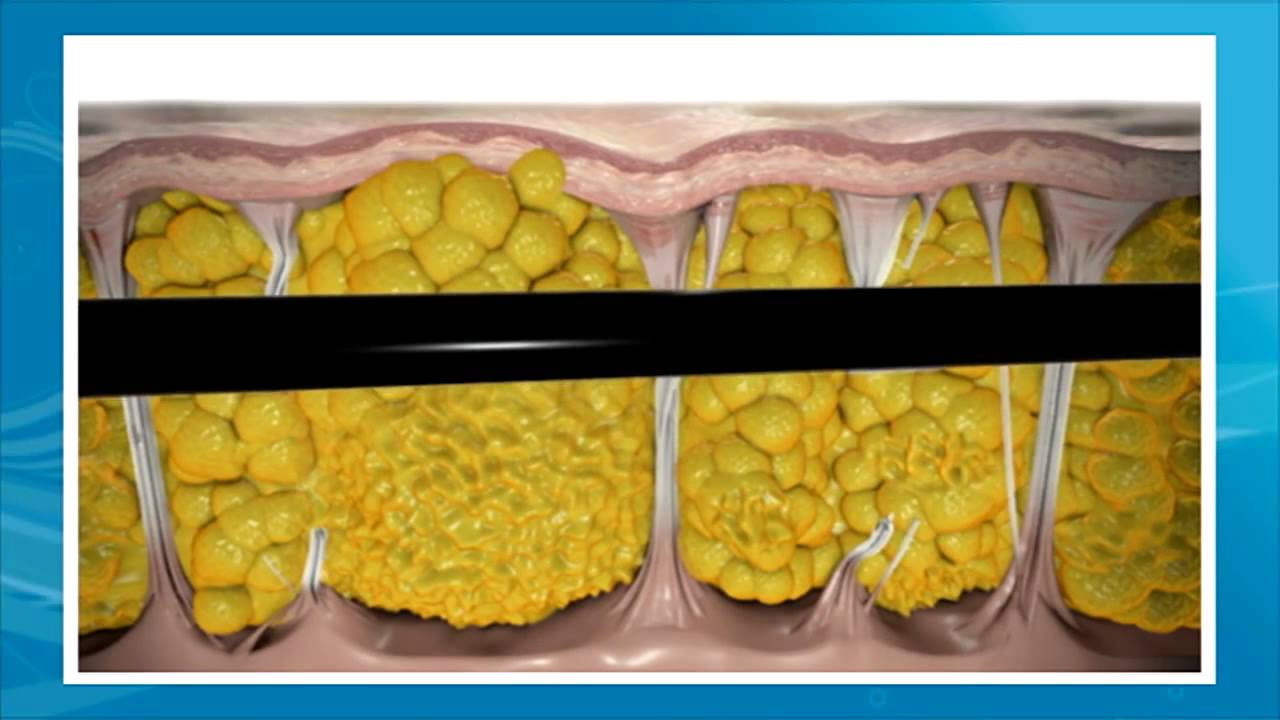 Cellulite Treatment at DYA Plastic Surgery Center of Huntsville Alabama ...