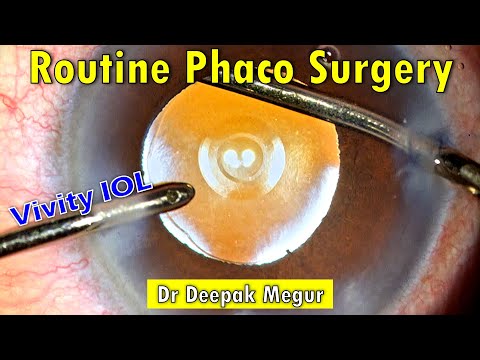 Routine Cataract Surgery with EDOF (VIVITY) Lens Implantation - Dr Deepak Megur
