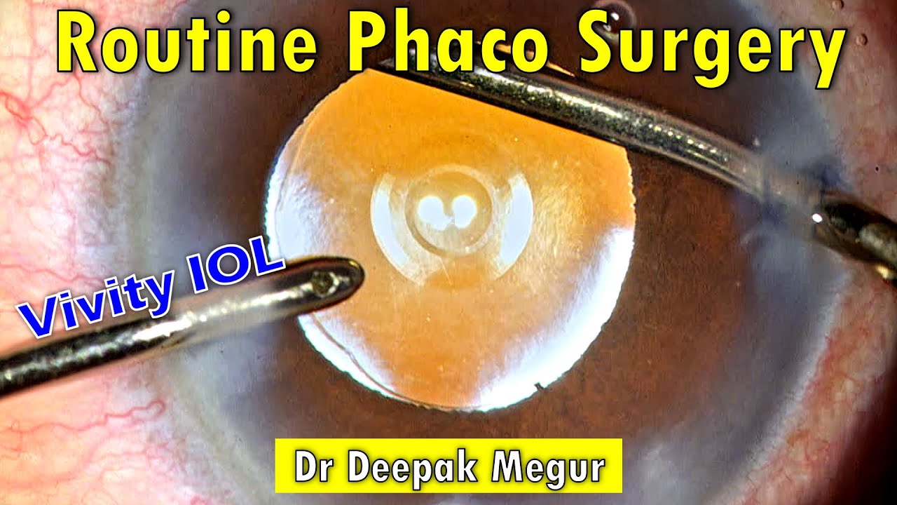 Routine Cataract Surgery with EDOF (VIVITY) Lens Implantation - Dr ...