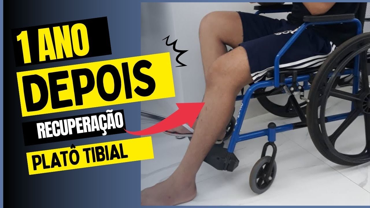 Como Estou? 1 ANO DEPOIS Recuperação Fratura Platô Tibial (Pós ...