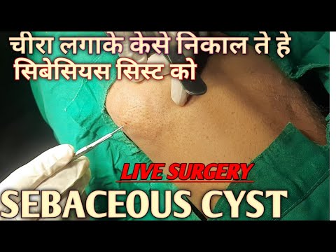 SEBACEOUS CYST REMOVE || सिबेसियस सिस्ट चीरा लगाके निकाल ते । #mbbs # ...