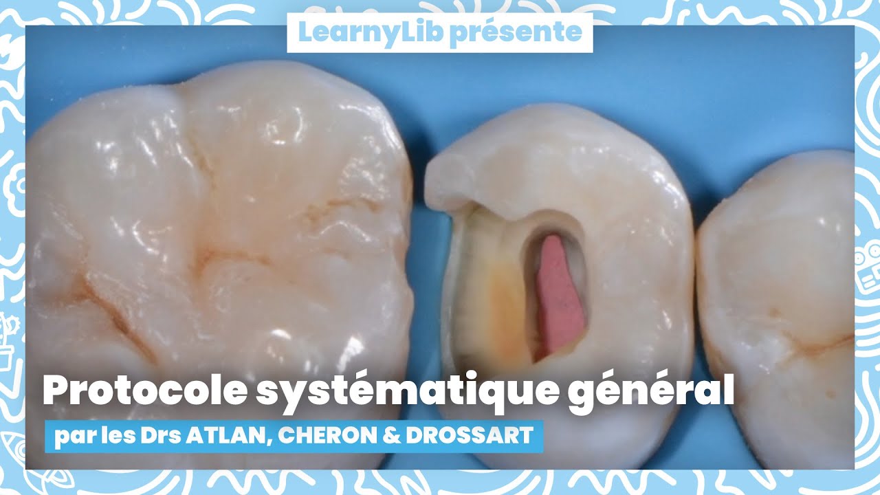 🦷 Inlays, Onlays : le protocole systématique général de préparation ...