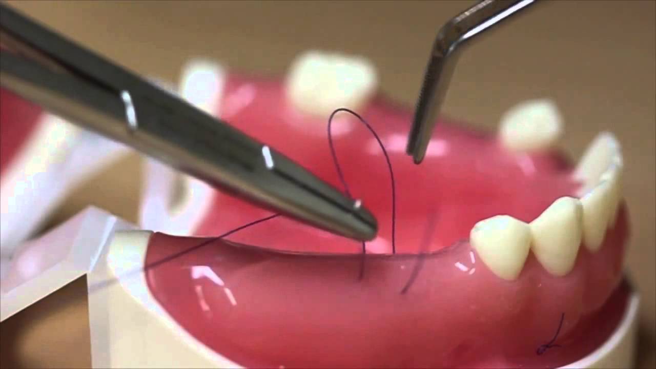 Back to the suture - #9 Modified Laurell Suture - YouTube