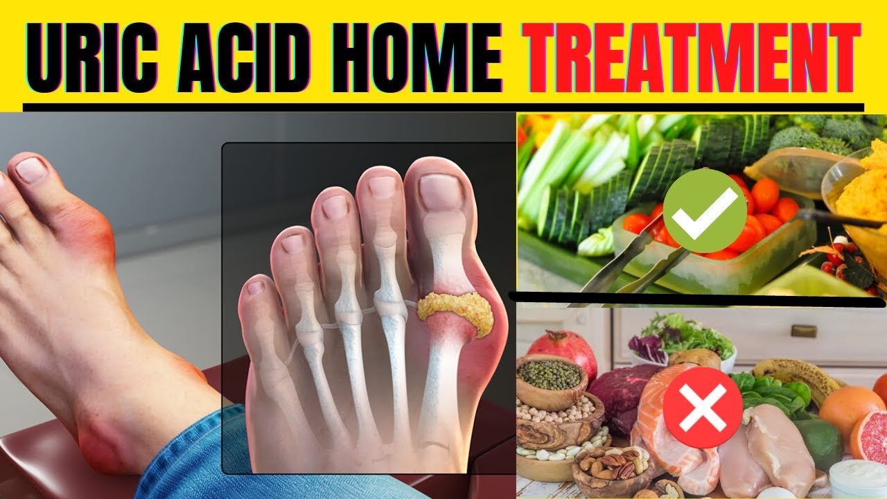 Uric acid home treatment | uric acid foods to avoid - YouTube