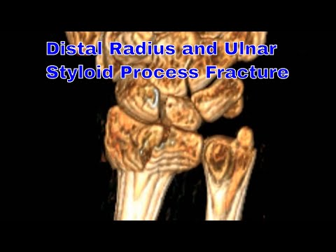 Distal Radius and Ulnar Styloid Process Fracture - YouTube
