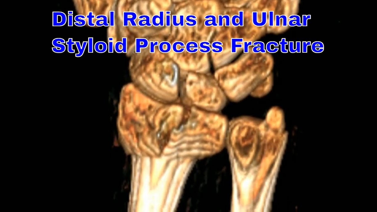 Don't Fracture Your Wrist! A Distal Radius And Ulnar Styloid Process ...