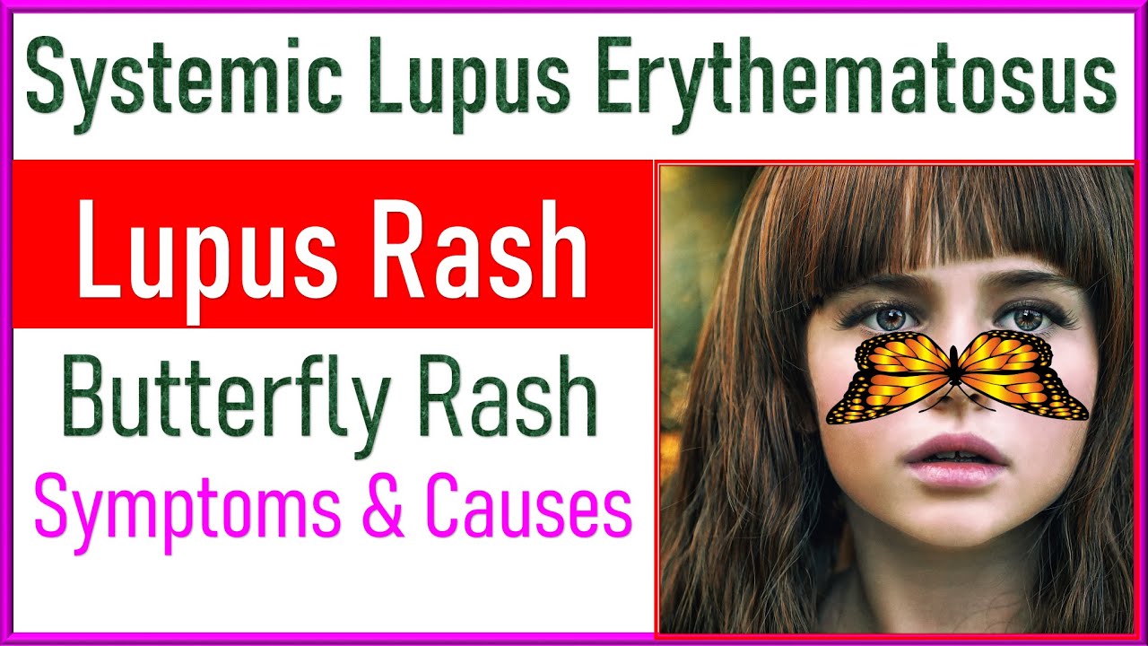 Systemic Lupus Erythematosus Disease | Lupus Rash Disease | Signs ...