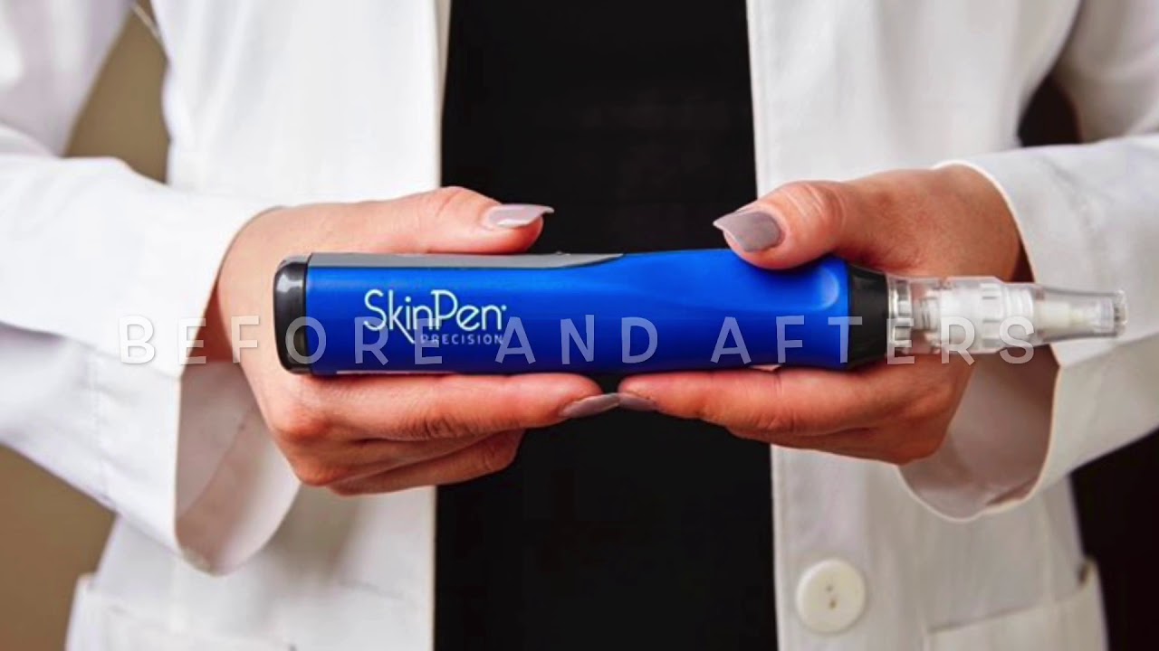 Skinpen precision before and after pictures - YouTube