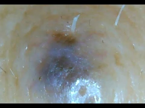 [pull out the beard]mole and under the lip - YouTube