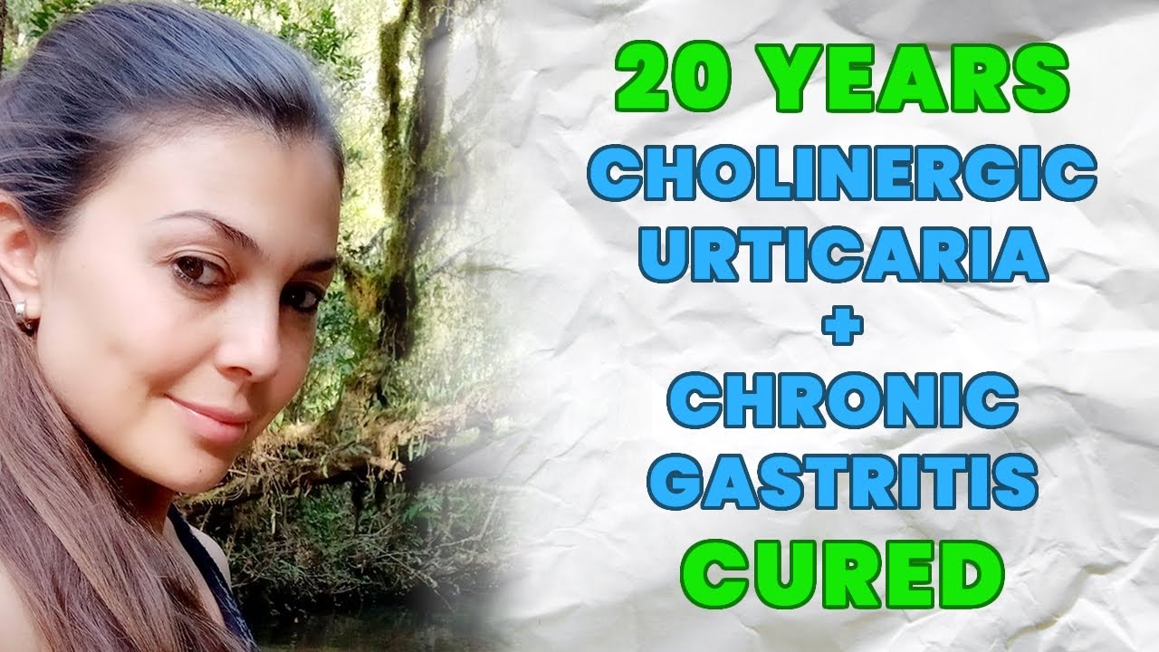 Cured of 20 years of cholinergic urticaria + chronic gastritis - YouTube