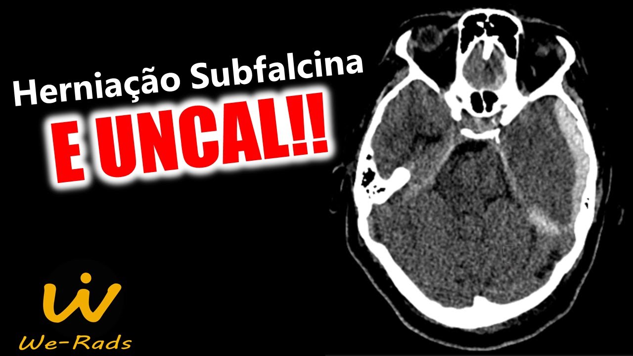 Herniação Subfalcina e Uncal na Tomografia - YouTube