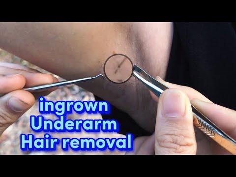 I Plucking ingrown Underarm hair on a nearly dark afternoon in an empty ...