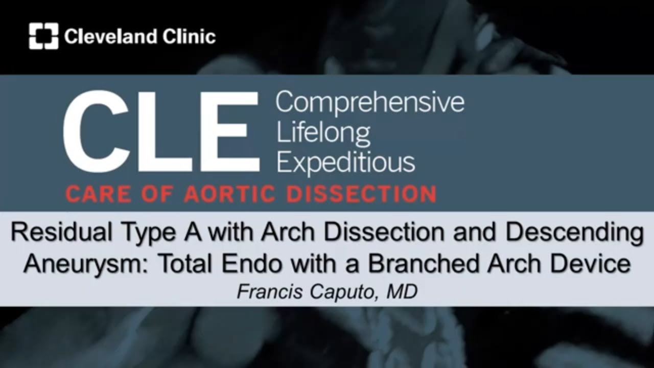 Residual Type A With Arch Dissection and Descending Aneurysm: Total ...