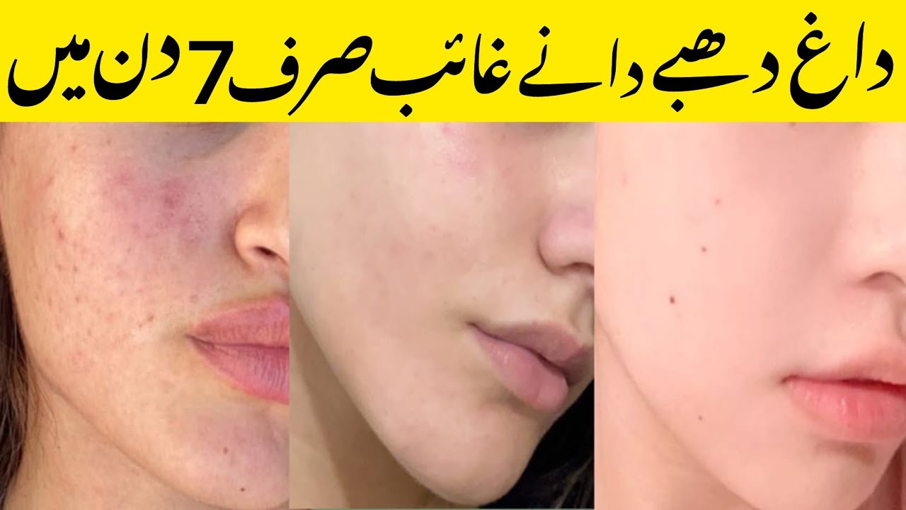 Blackheads Removal | Acne pimple treatment | dark spot treatment ...