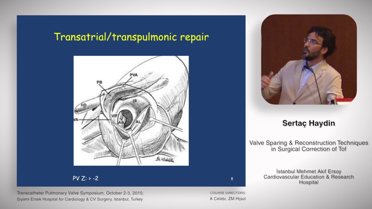 Sertac Haydin - Valve sparing and reconstruction techniques in surgical ...