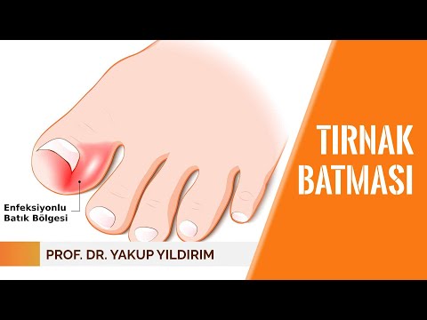 Tırnak batması neden olur? Nasıl tedavi edilir? | Prof. Dr. Yakup YILDIRIM
