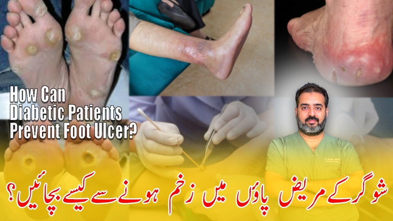 How to Prevent Foot Ulcers in Diabetes | Diabetic Foot Care Tips - YouTube