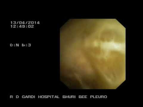 Dr Varudkar's technique of pleuroscopy. - YouTube