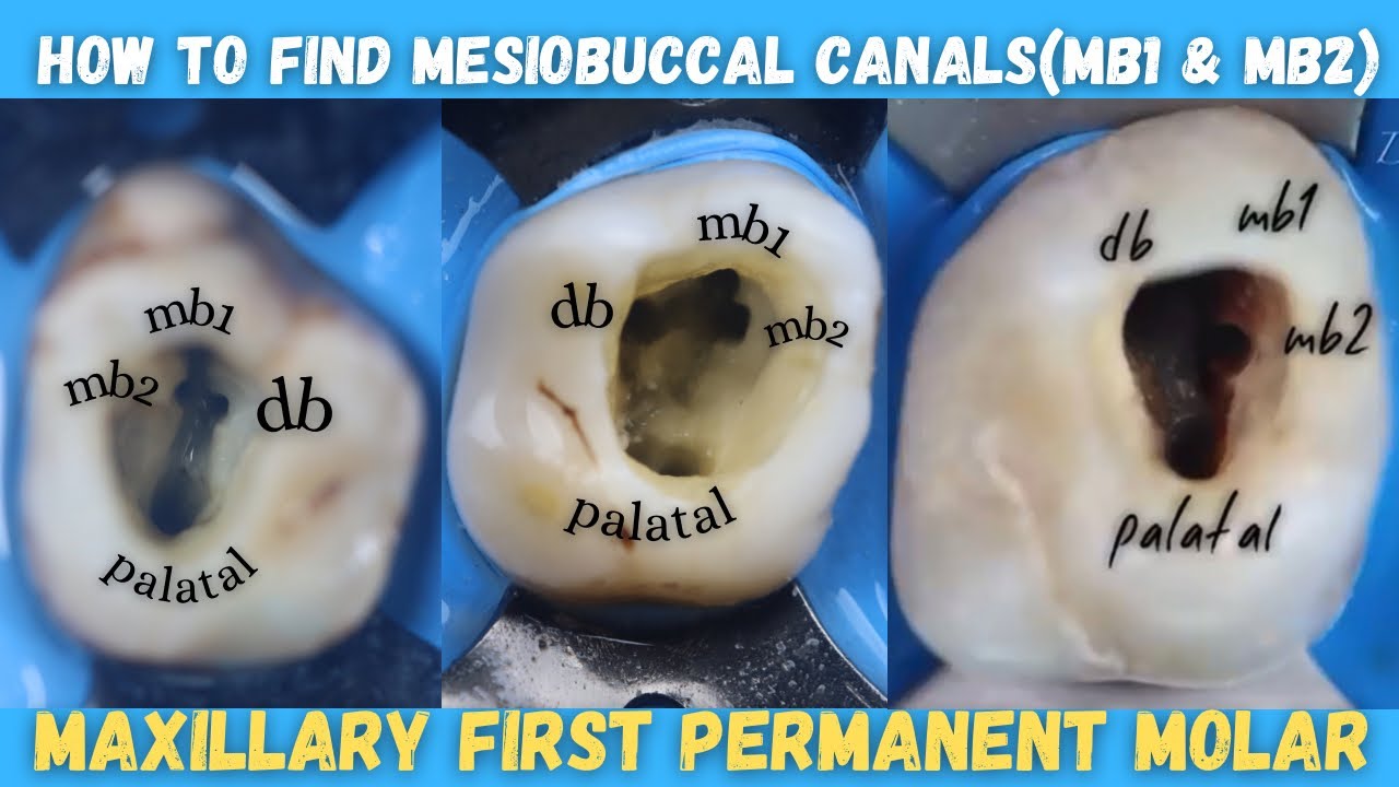 How To Locate Mesiobuccal Canals(mb1 & mb2) in Maxillary First ...