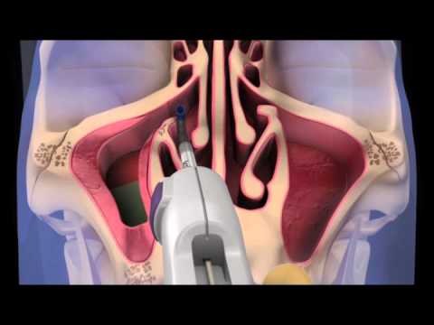 Acclarent Spin Balloon Sinuplasty Animation - YouTube