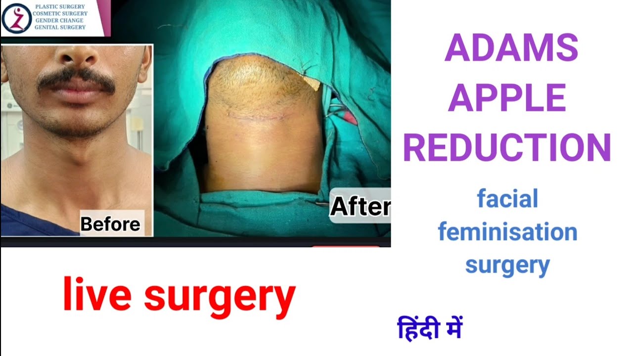 ADAMS APPLE REDUCTION INDIA MUMBAI DELHI LUCKNOW HYDERABAD BANGALORE ...