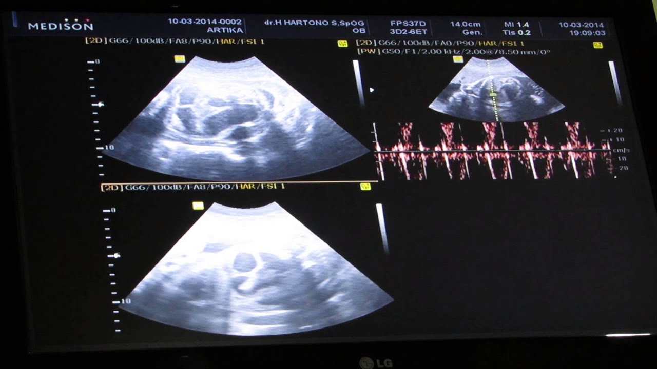 USG kehamilan 30 minggu | fetal development 30 weeks - YouTube
