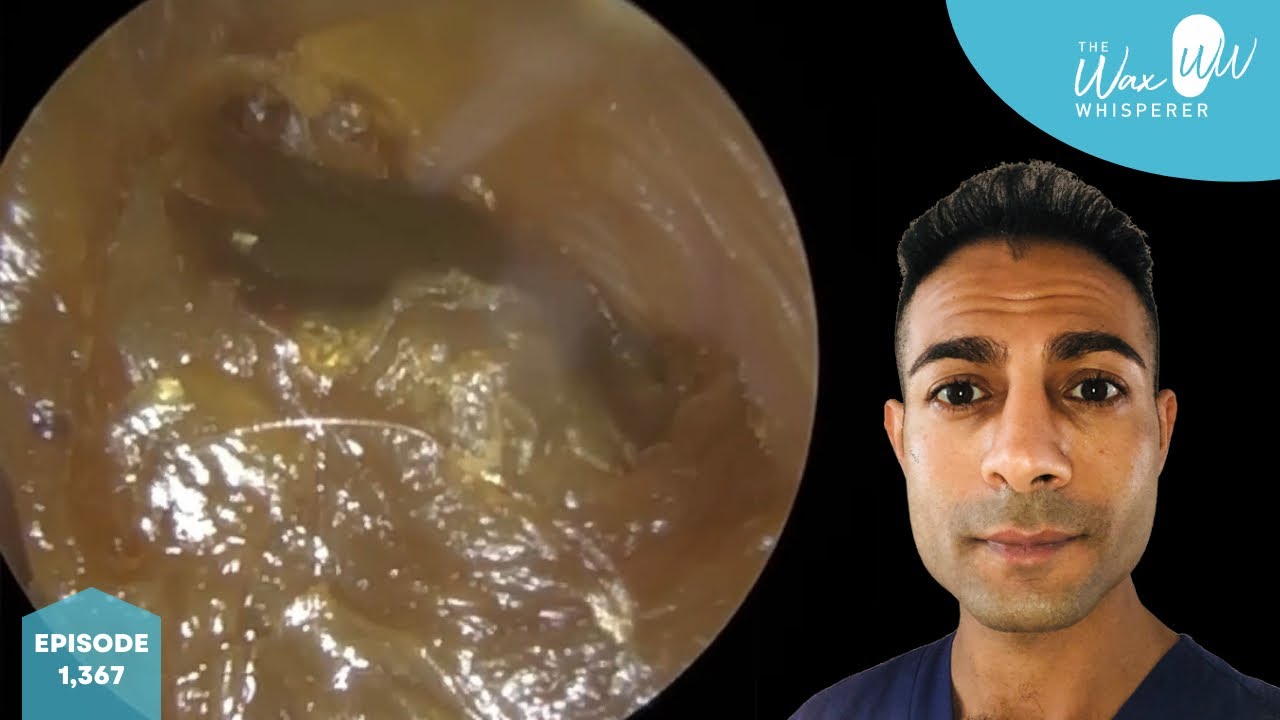 1,367 - Dry Crusted Glossy Dead Skin & Keratin Trapped inside Deep ...