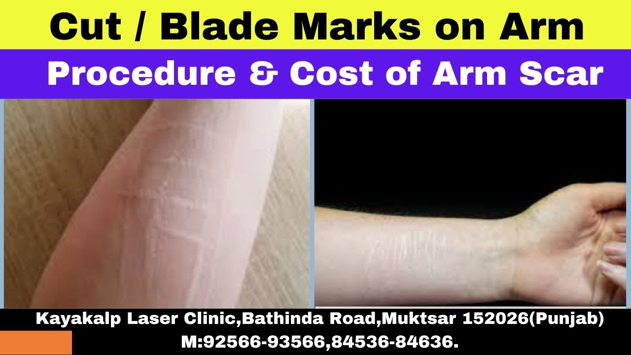 Cut / Blade Marks on Arm | Procedure & Cost of Arm Scar - YouTube