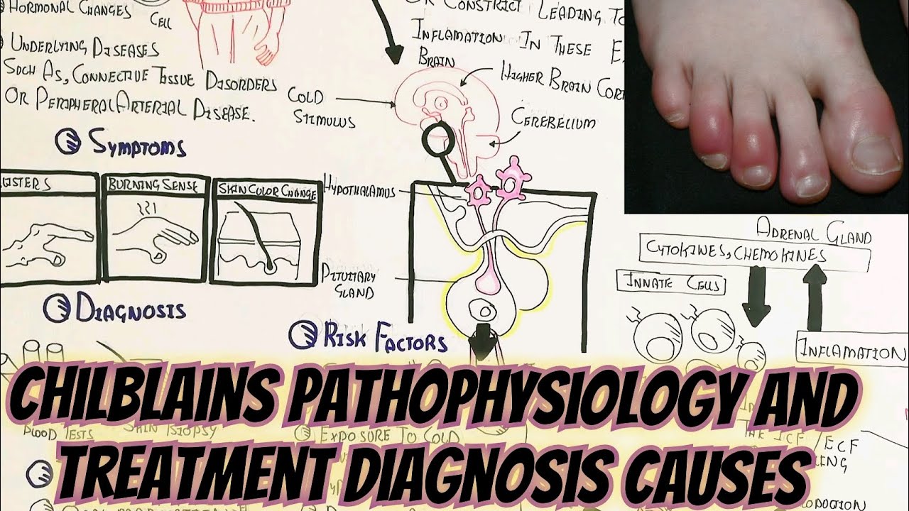 Chilblains(perniosis)Pathophysiology|Treatment Sign|Symptom|Diagnosis ...