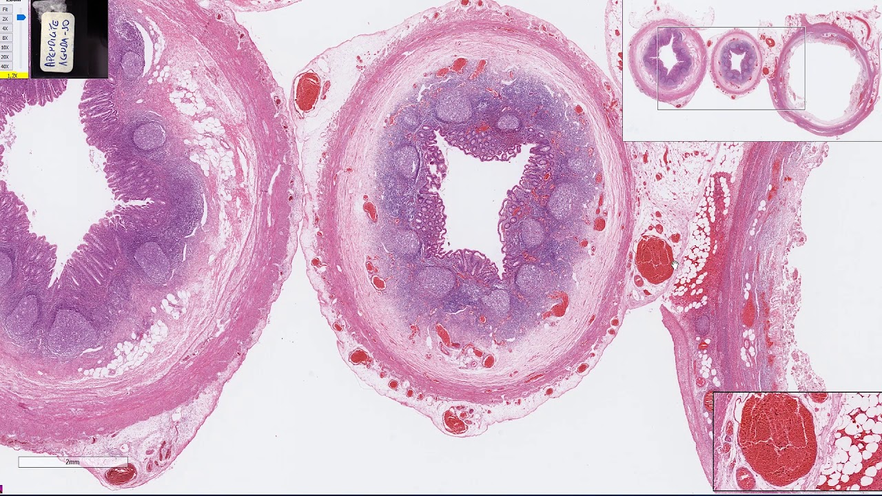 Inflamação aguda, apendicite - Patologia Geral - YouTube
