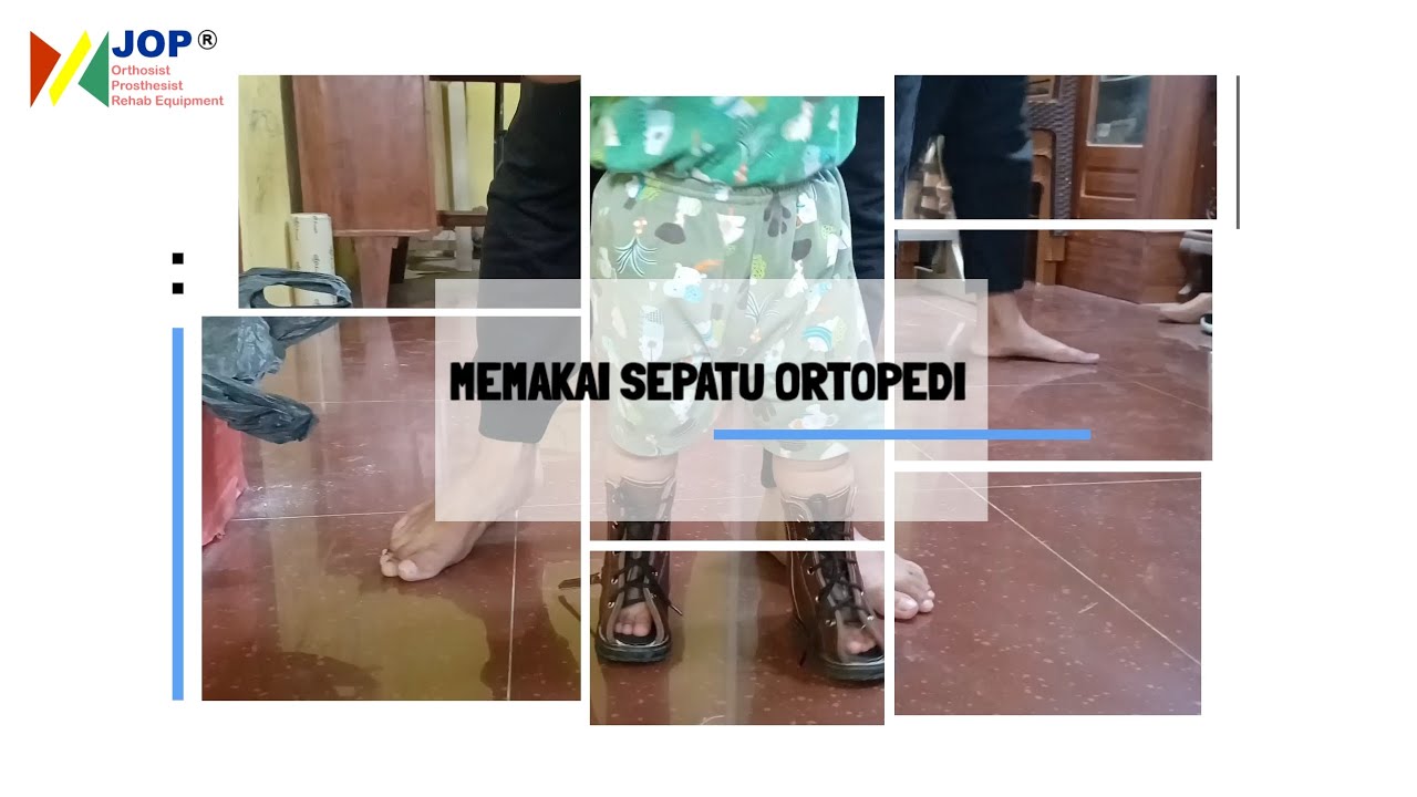 PAKAI SEPATU ORTOPEDI PADA KONDISI KELAINAN KAKI BAYI PENGKOR DAN ...