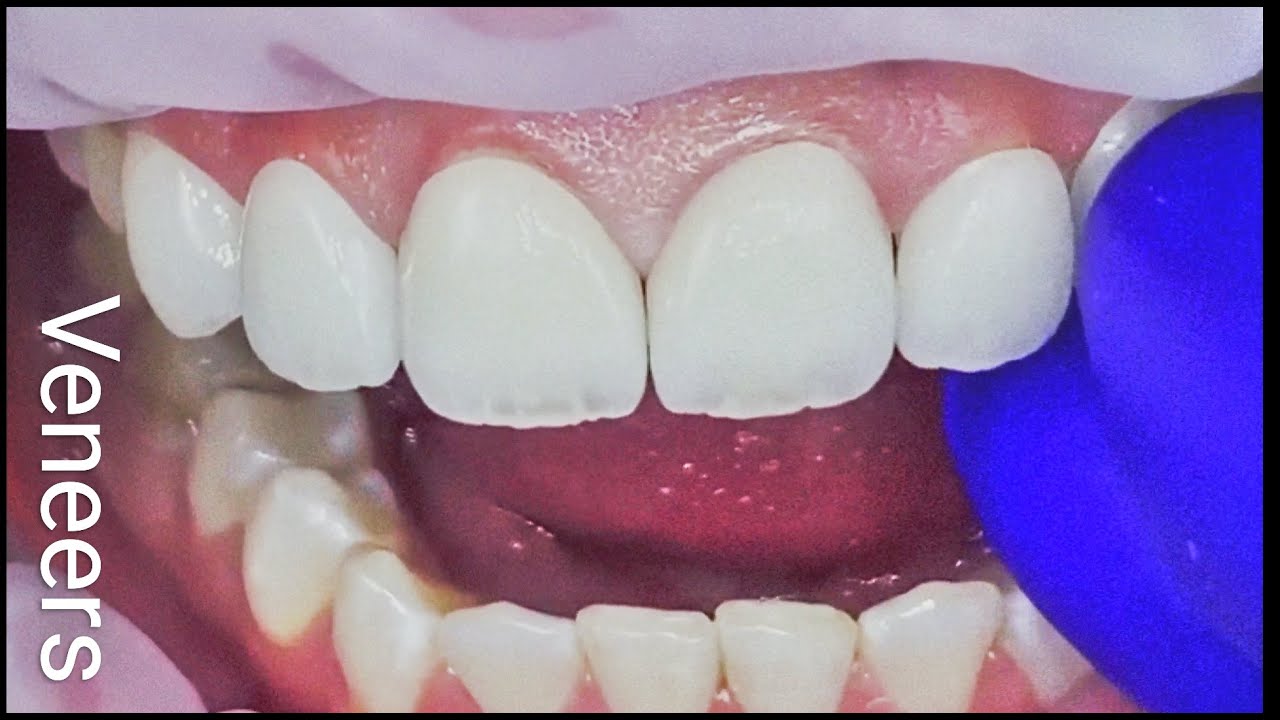 how each one is cemented in place emax veneers - YouTube