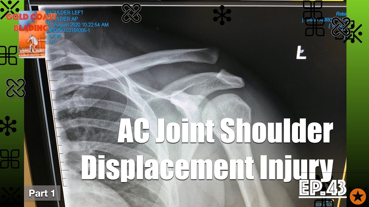 AC Joint Injury Shoulder separation Grade 3 or Grade 5? Pre-surgery ...