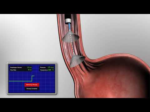Aqua Circumferential Ablation Catheter - YouTube