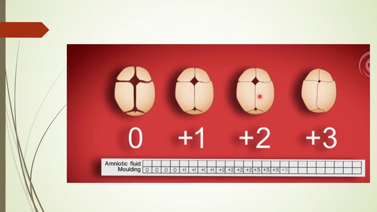 How to fill a partograph - YouTube