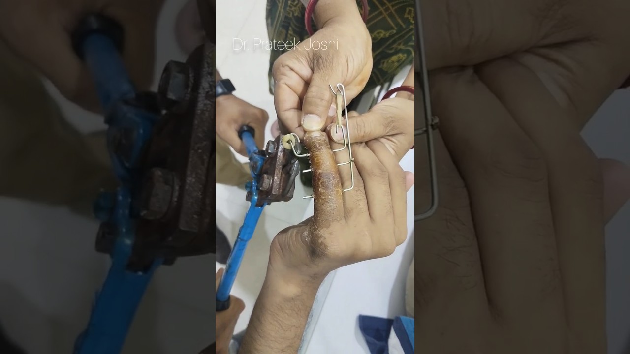 Suzuki Frame K wire Removal Procedure | Dr. Prateek Joshi #ortho #kwire ...