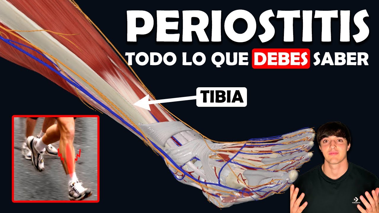 PERIOSTITIS TIBIAL: Su TRATAMIENTO y lo que debes saber - YouTube
